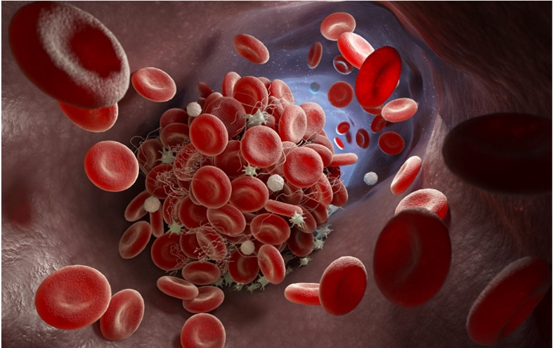 Traitement de la myélofibrose. Une nouvelle option thérapeutique avec ...