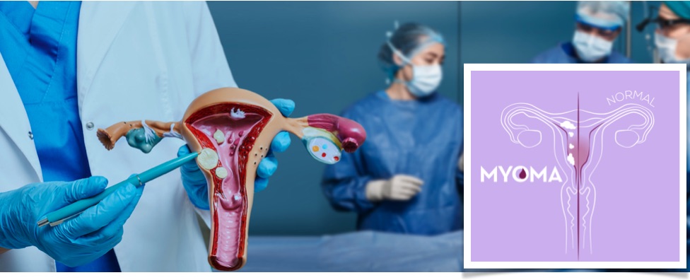 Faisabilité et résultats chirurgicaux de la myomectomie hystéroscopique du myome FIGO de type 3 ...