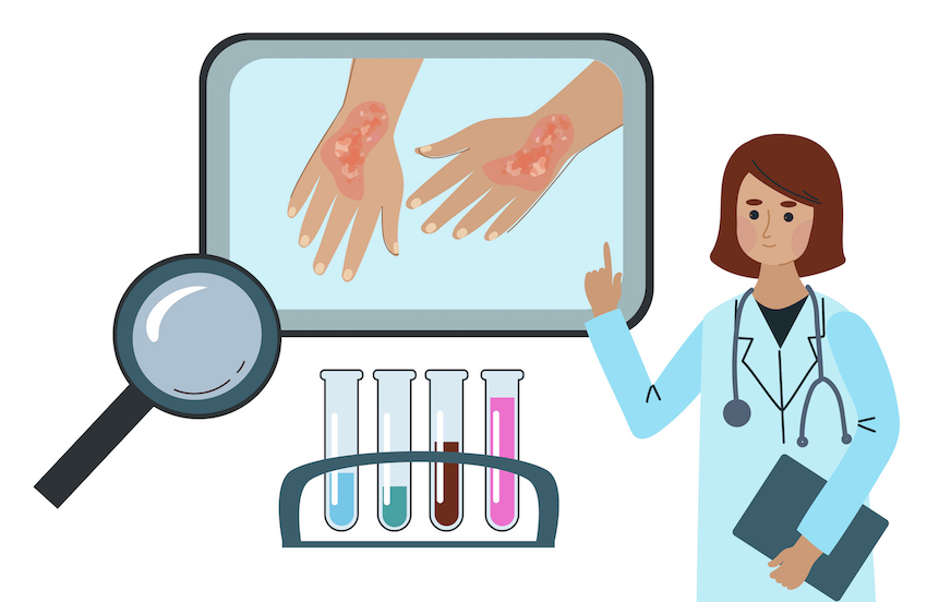 Informer et éduquer les patients réduit la sévérité de la dermatite ...