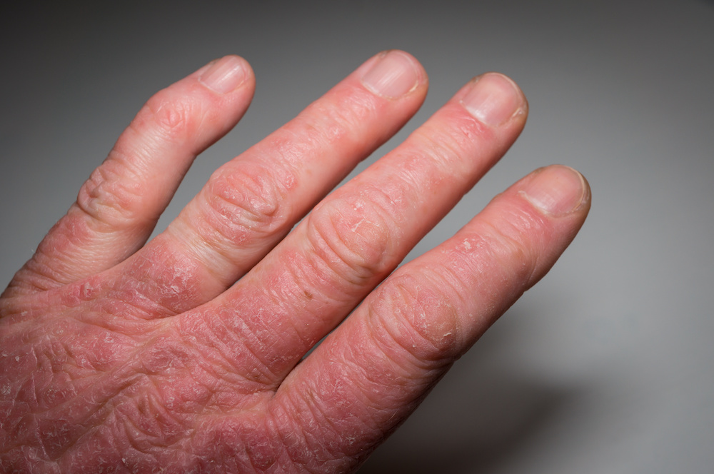 Psoriasis : les agents ciblant l'IL-23 plus efficaces que les anti-TNF ...