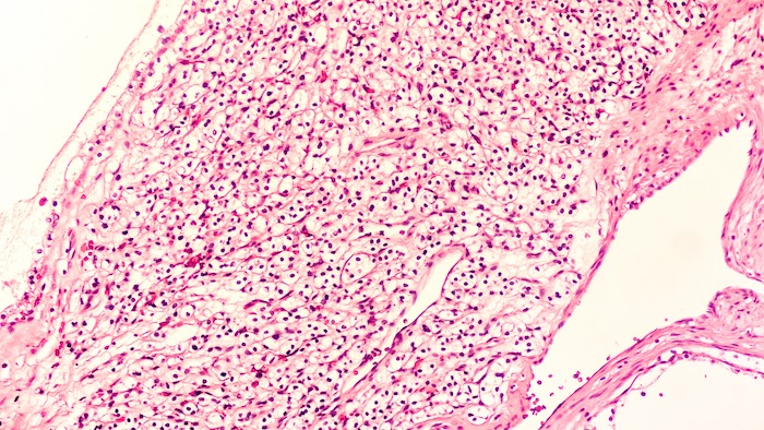 Carcinome rénal à cellules claires métastatique : des résultats qui ...