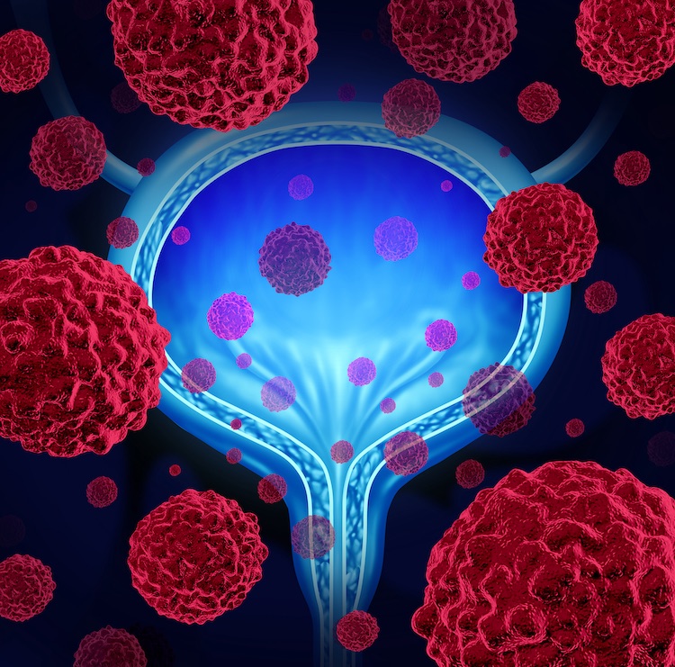 Van behandeling van blaaskanker naar een pantumorale behandelstrategie ...