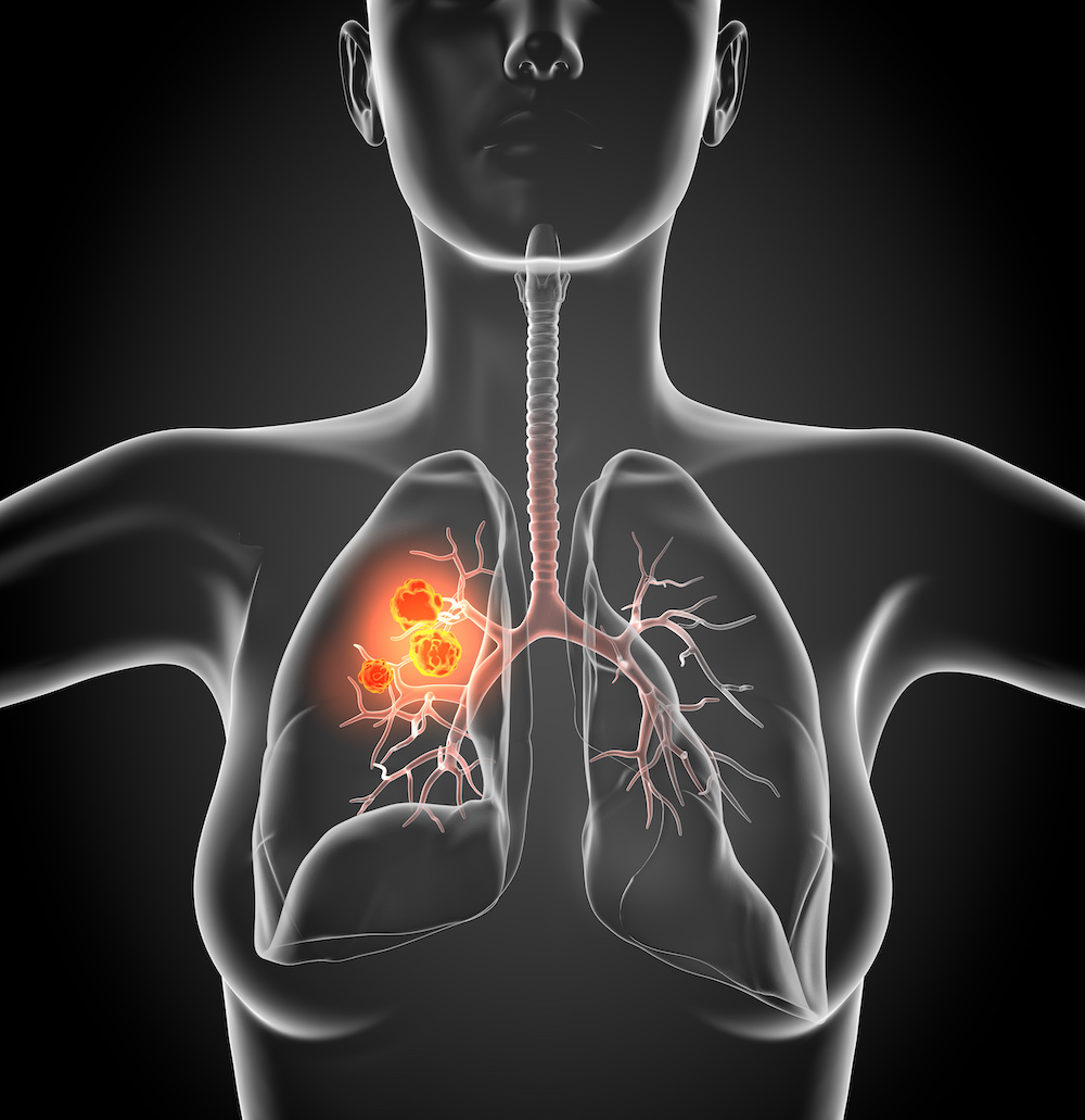 ALK+ niet-kleincellige longkanker: werkzaamheid van een gerichte ...