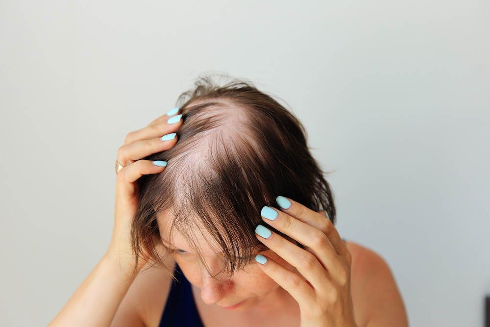 Alopecia totalis: combinatie methotrexaat en prednison goed voor ...