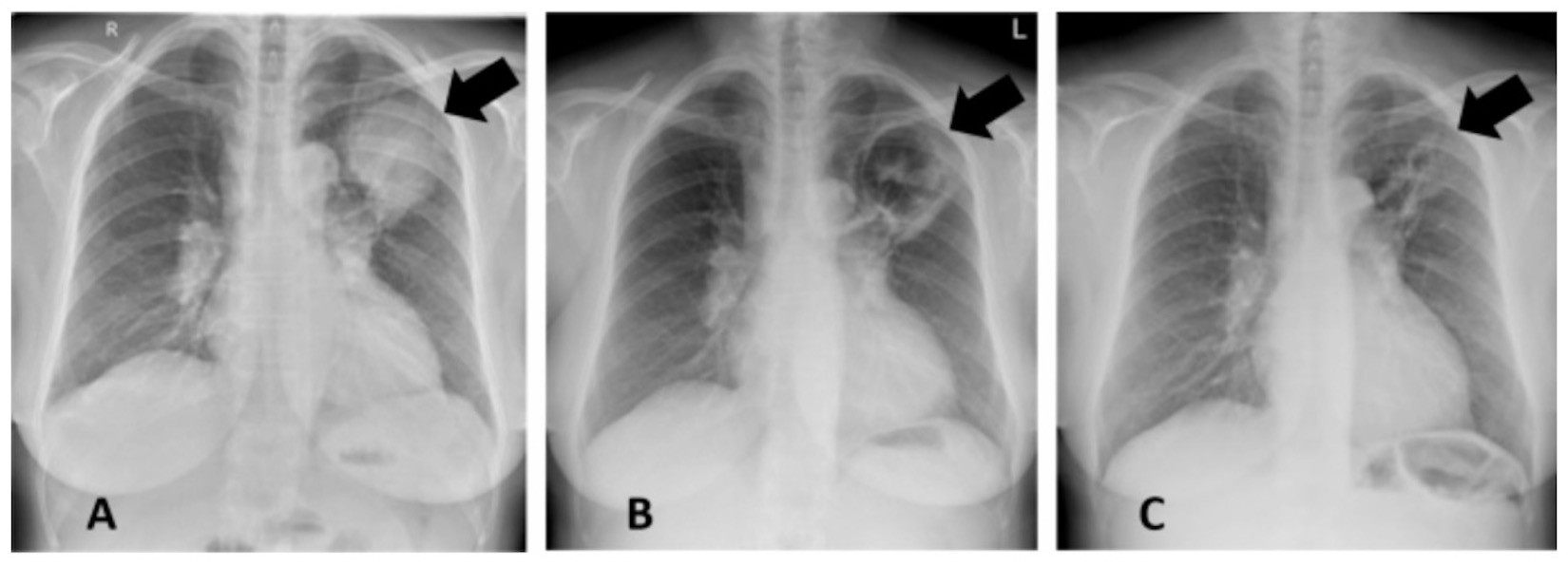 Pneumonie à Legionella avec abcès pulmonaires : comment traiter en l ...