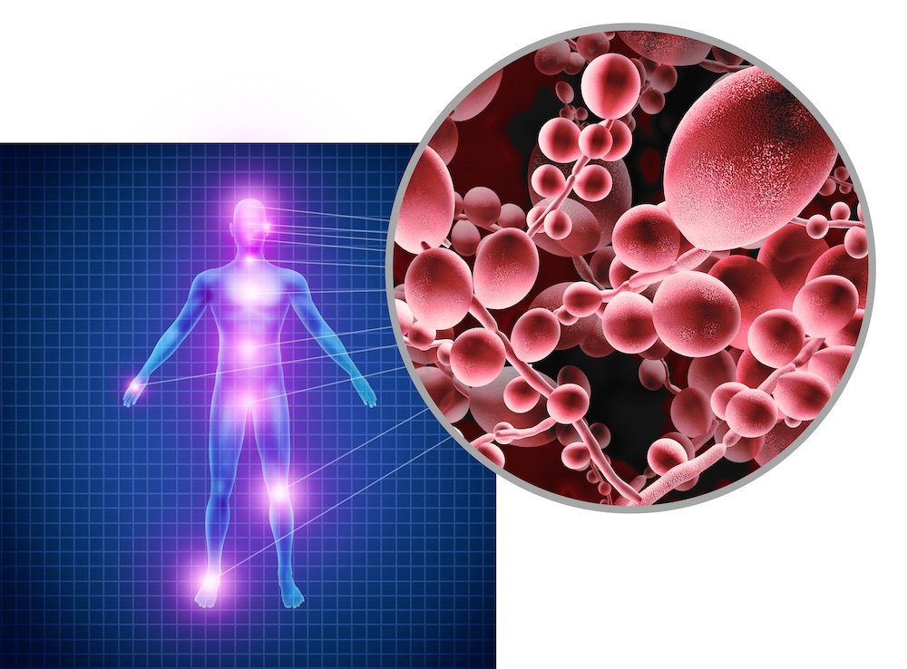 Traitement des mucormycoses : l’épidémiologie amène à modifier la ...