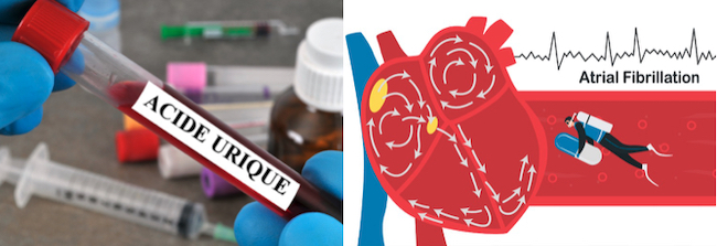 Een hoog urinezuurgehalte correleert met een hoger risico op ...