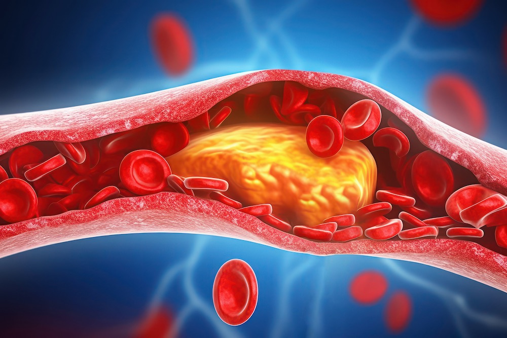 Atriumfibrillatie: statines verlagen het risico op CVA - MediQuality