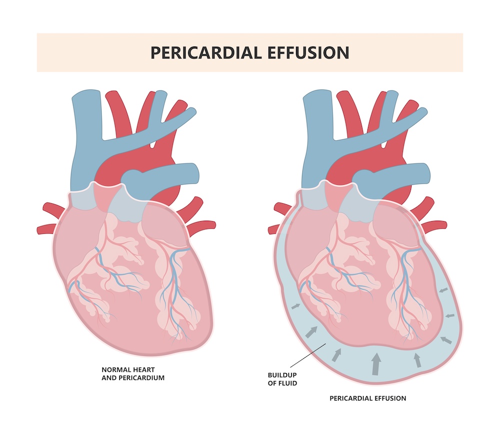 Lagere body mass index correleert met hoger risico op harttamponnade ...
