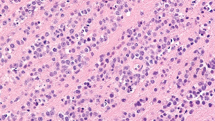 Lymphomes diffus à grandes cellules B en rechute/réfractaire : les ...