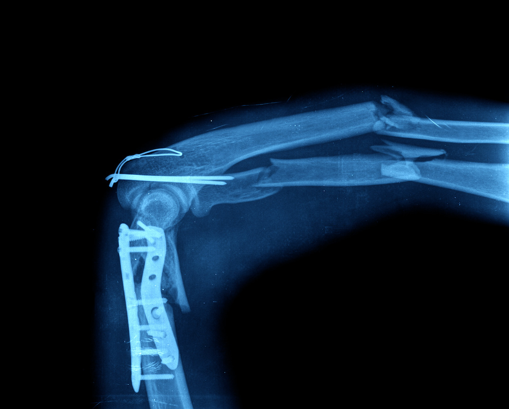 Ostéoporose, santé osseuse et fractures périprothétiques - MediQuality