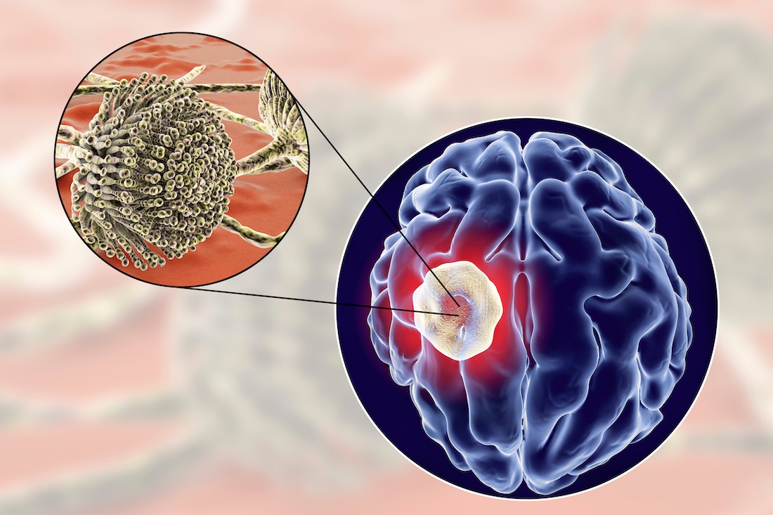 Traitement des aspergilloses cérébrales : quel antifongique choisir ...