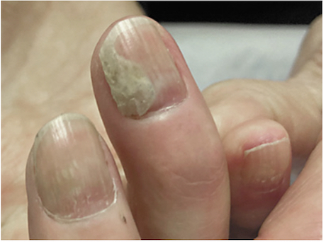 Onychomycose des doigts et sclérodermie. Un dérivé azolé per os ou ...