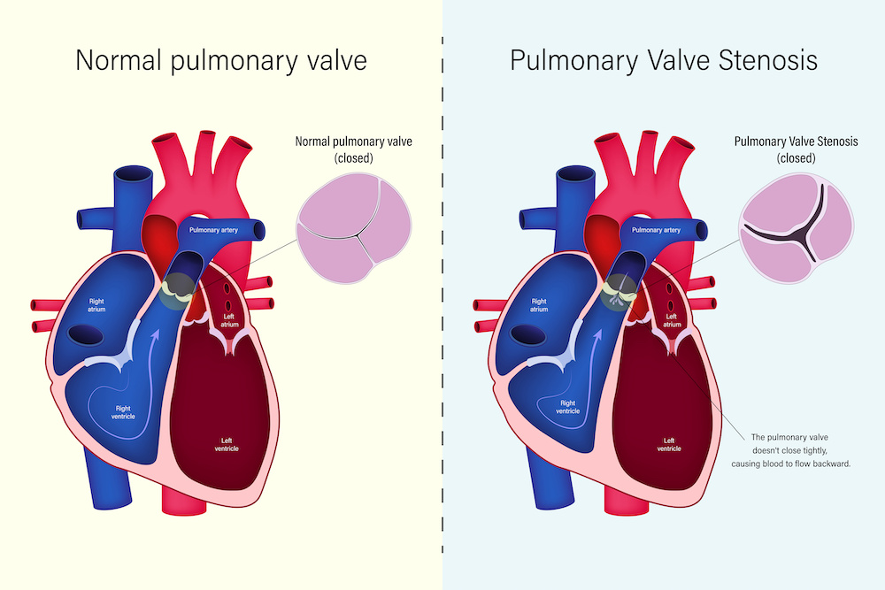 Remplacement de valves pulmonaires et endocardites infectieuses : quel ...