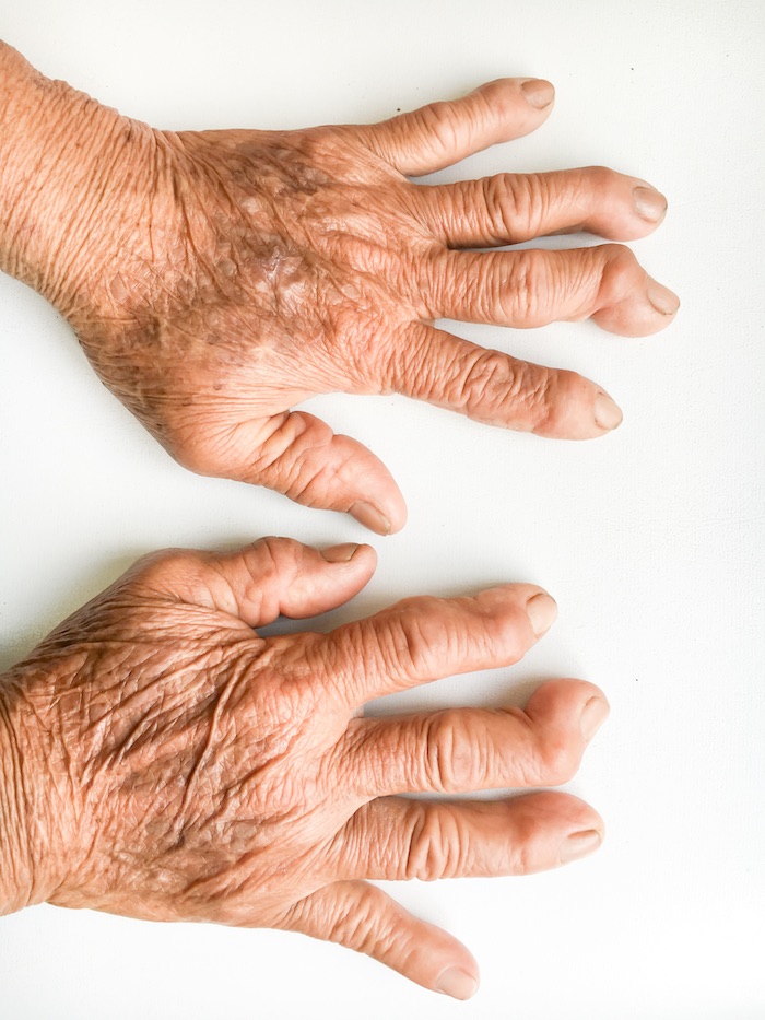 Erosieve artrose van de vingers: waarom geen RANKL-antagonist ...