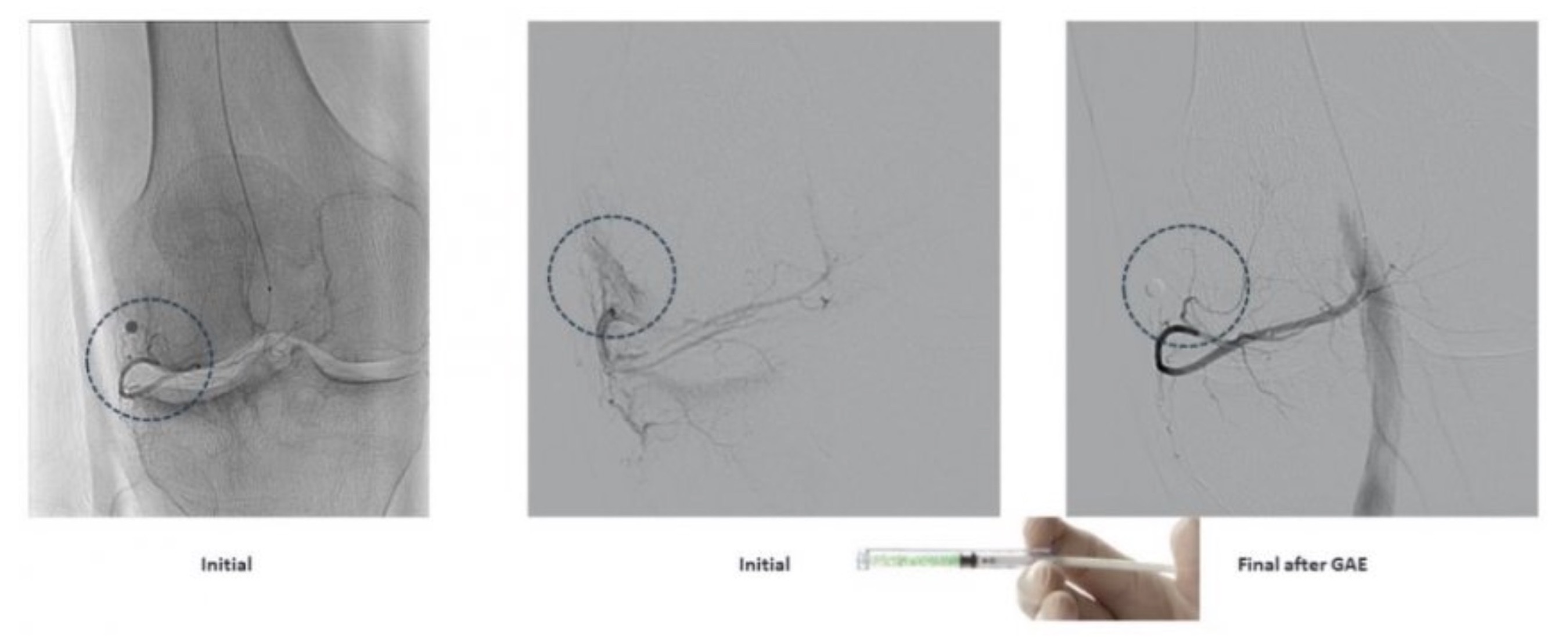 Knieartrose die niet reageert op de medische behandeling: pijnstillende ...