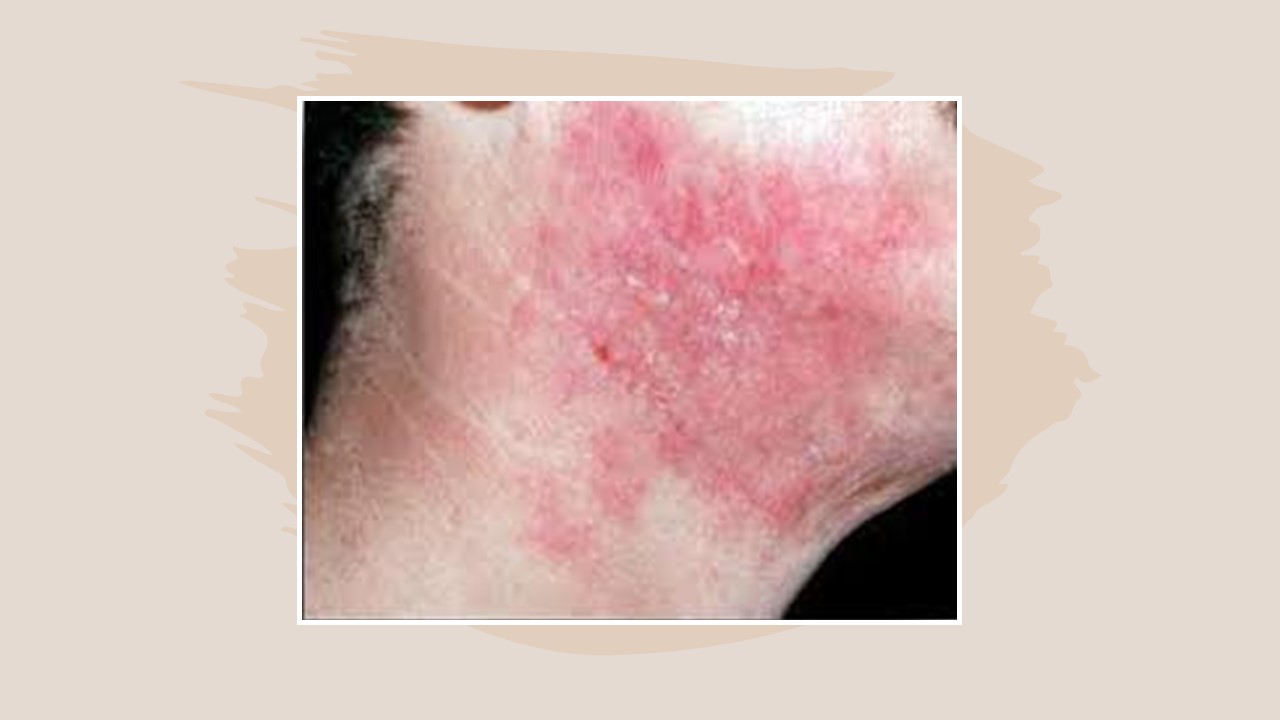 Behandeling van matig ernstige tot ernstige atopische dermatitis. Een ...