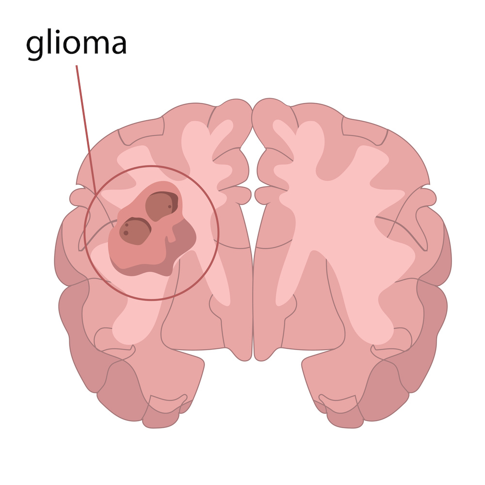 Epilepsie et gliomes : quel traitement de première ligne ? - MediQuality