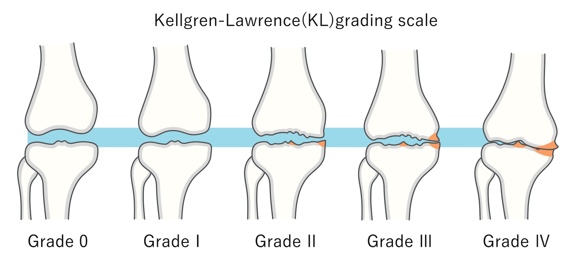 Pijnlijke artrose van de knie: celtherapie even goed als ...