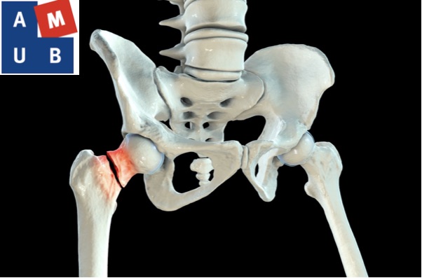 Fracture du col du fémur chez une personne âgée : le rôle clé du ...