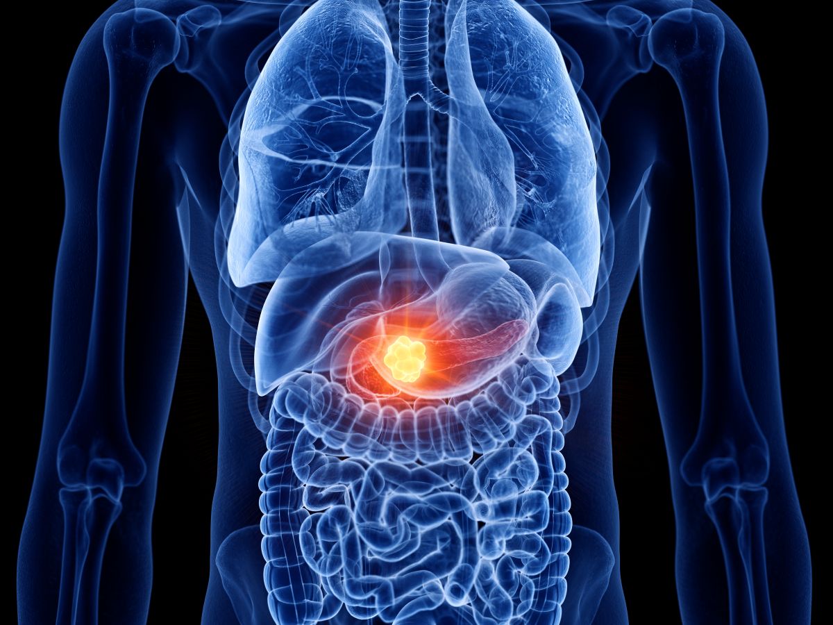 Cancer du pancréas : faut-il chercher du côté du microbiote buccal ...