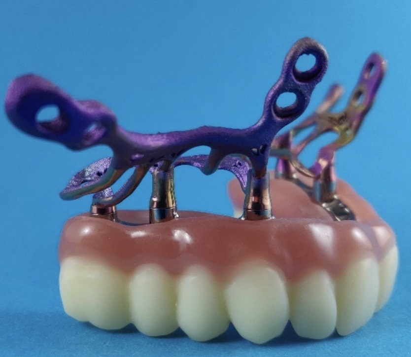 Un implant en titane est une alternative pour les patients souffrant d ...